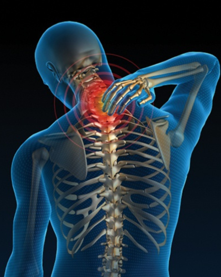Cervicogenic Headaches – Bashir Neurology